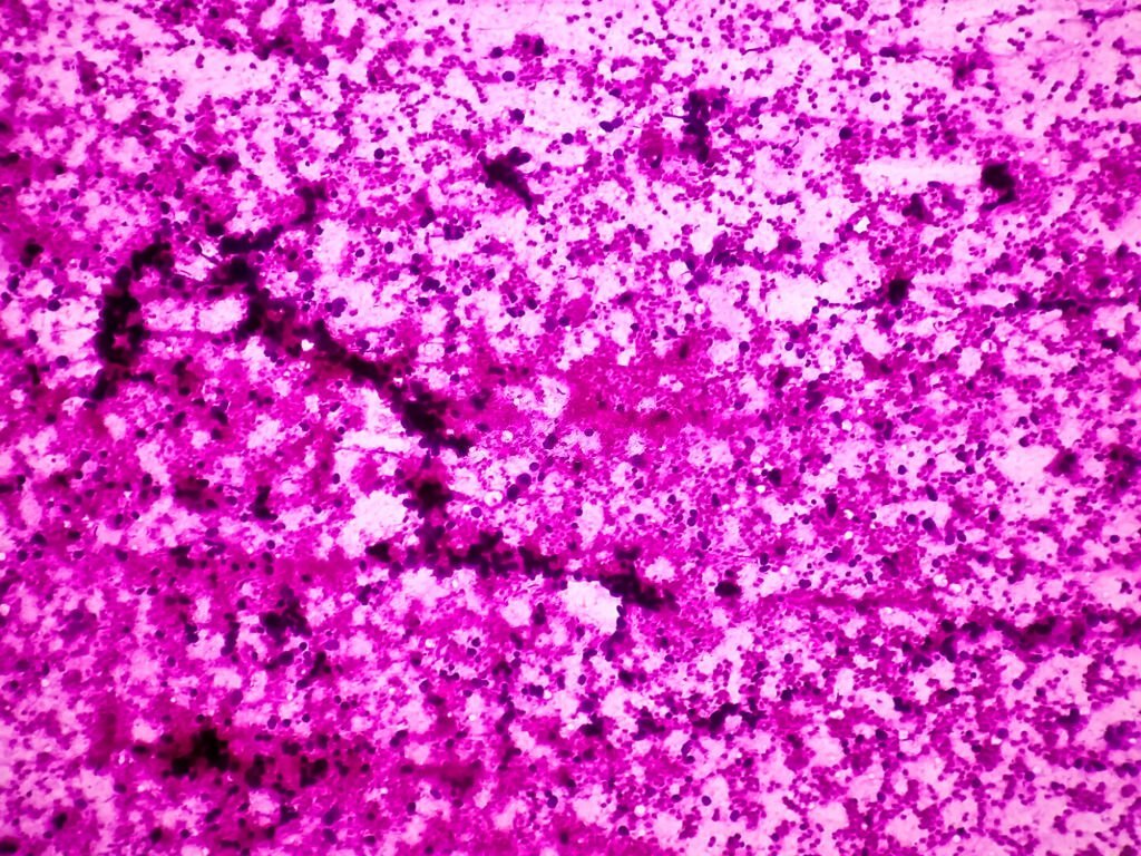 Top Notch Cancer Treatment and Services in Patna